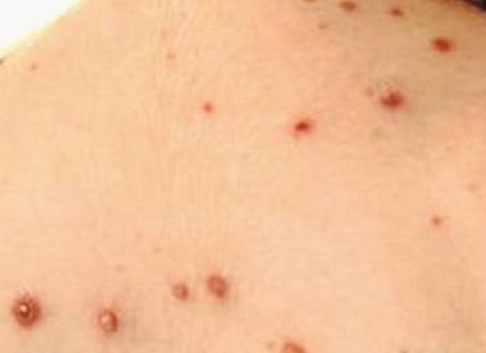 Morbillo killer in Sicilia, metà dei casi italiani sono a Catania ...