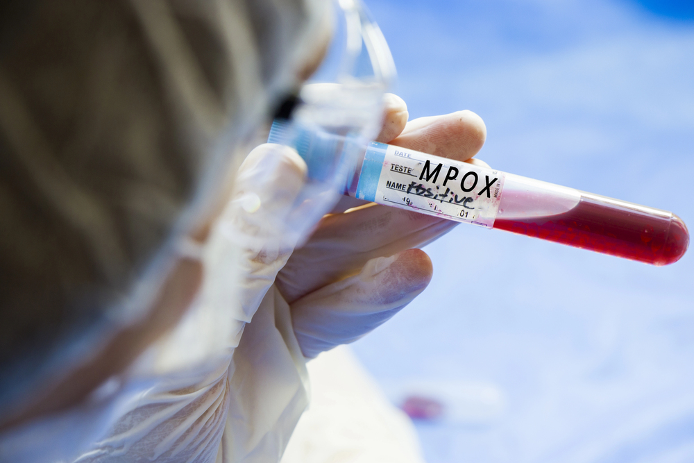 Virus Mpox, i sintomi e la modalità di trasmissione della variante Clade IB