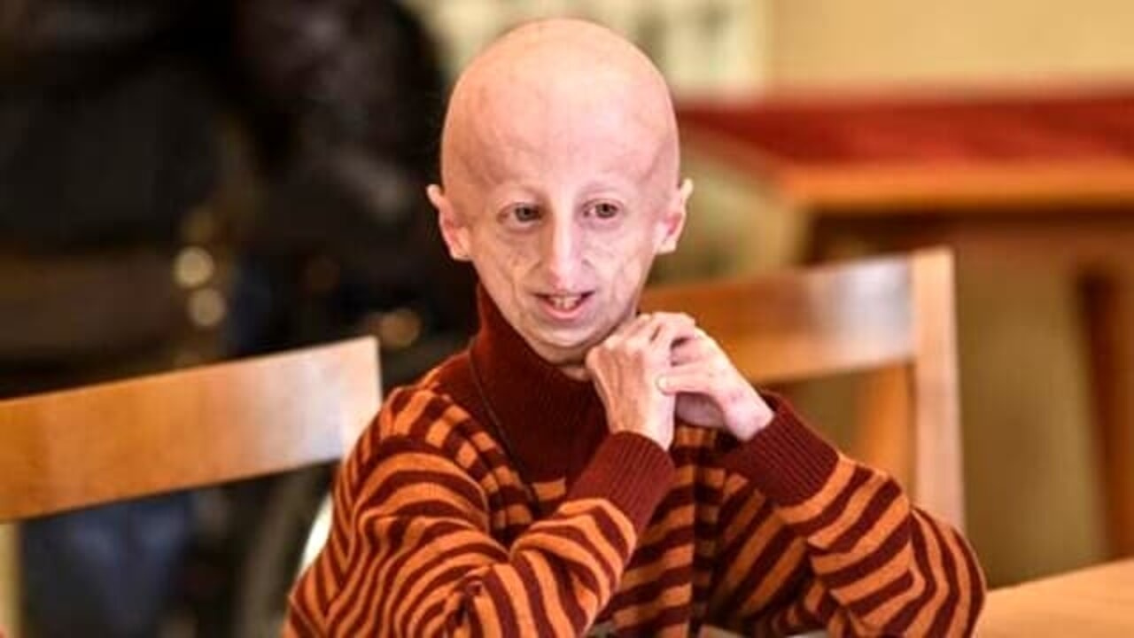 Addio a Sammy Basso, il più longevo malato di progeria